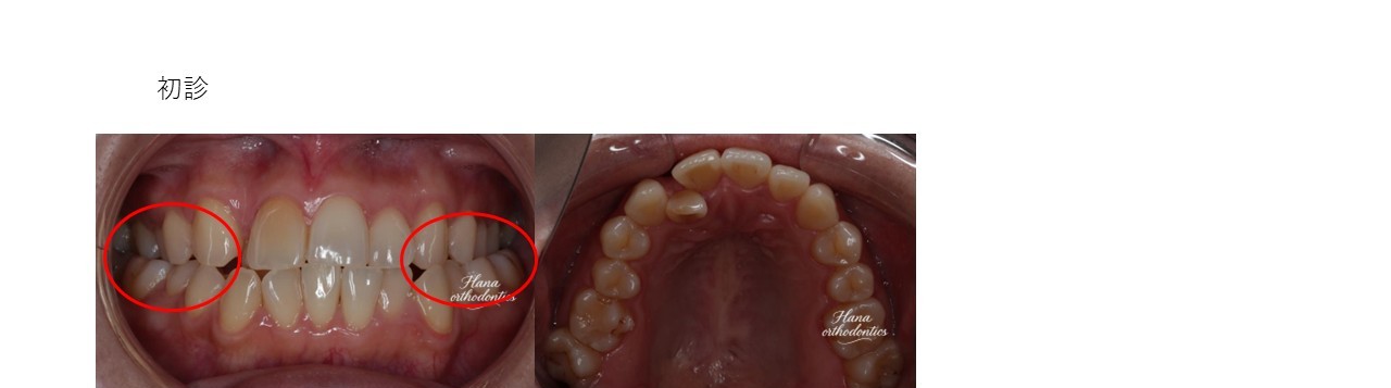 MSE（Maxillary Skeletal Expander）とは？従来の拡大装置との違いを解説 – 品川区大井町の矯正歯科｜花矯正歯科 ...